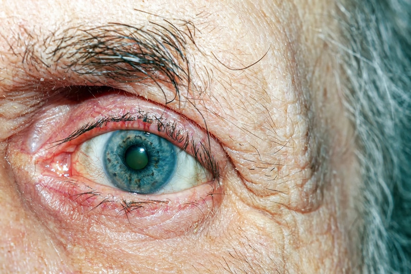 High Blood Pressure Can Affect Your Vision - Your Health Magazine