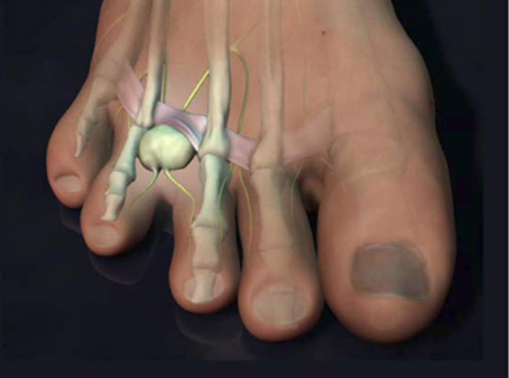 Foot Health: Neuromas - Your Health Magazine