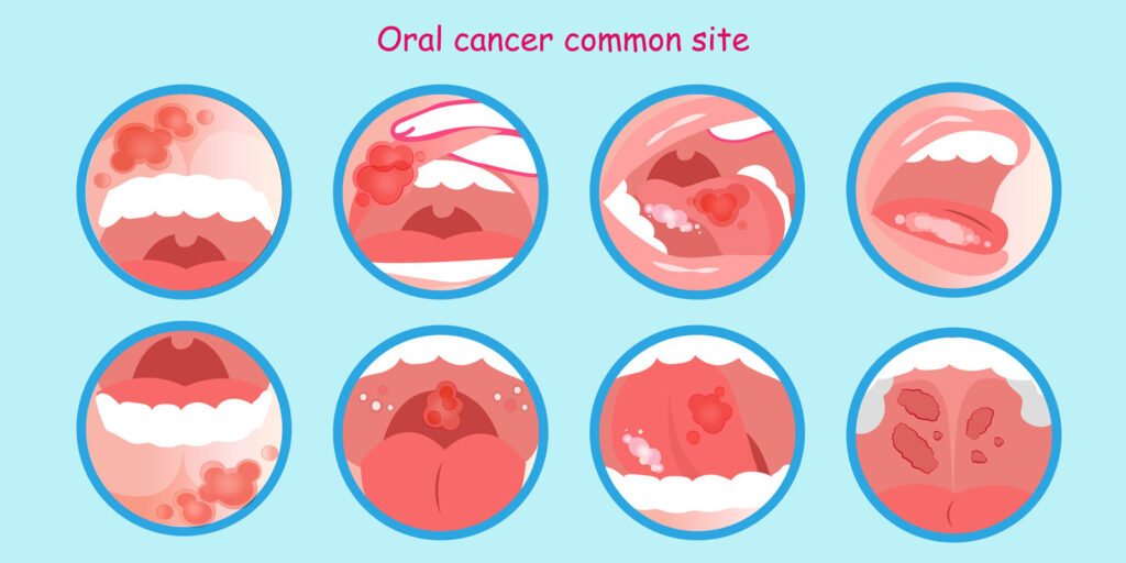 Oral Cancer: What You Need To Know - Your Health Magazine