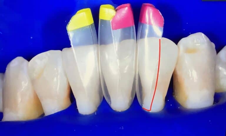 Advances In Cosmetic Dentistry – The Bioclear Matrix System - Your ...