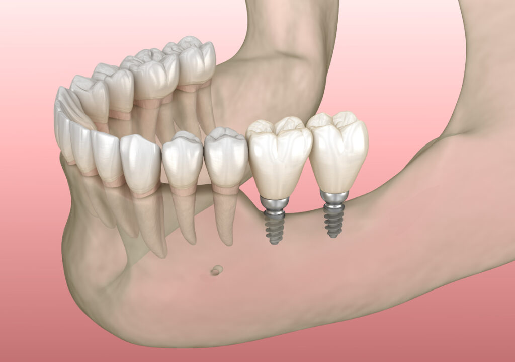 Immediate Mini Dental Implants - Your Health Magazine
