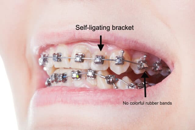 “Self-Ligating” Braces: State-Of-the-Art Orthodontics - Your Health ...