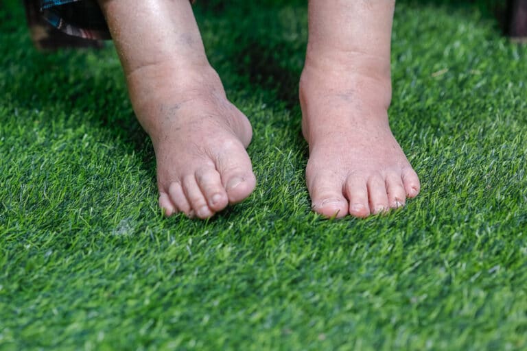 Poor Circulation In Feet - Your Health Magazine