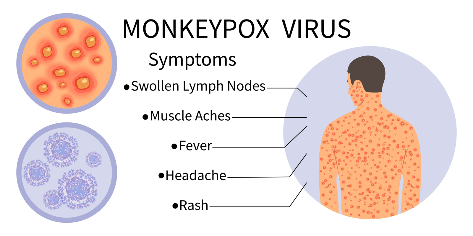 Monkeypox Outbreak in the U.S. - Your Health Magazine
