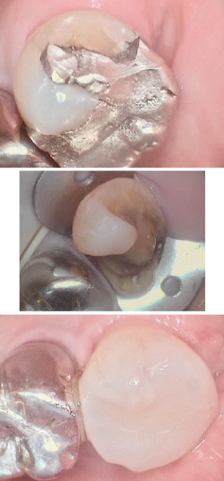 Bioclear – A Very Conservative Approach In Preserving Tooth - Your ...