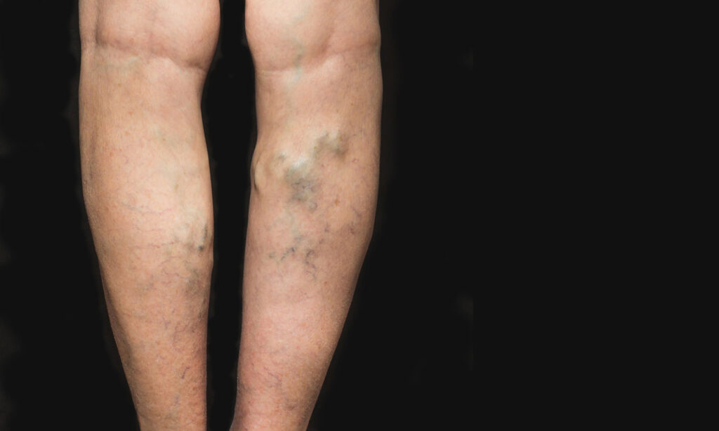 What Are Varicose and Spider Veins? - Your Health Magazine