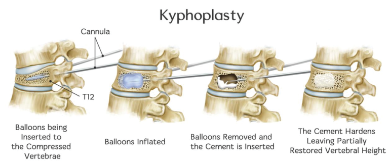 Kyphoplasty: Treatment For Spinal Compression Fractures - Your Health ...
