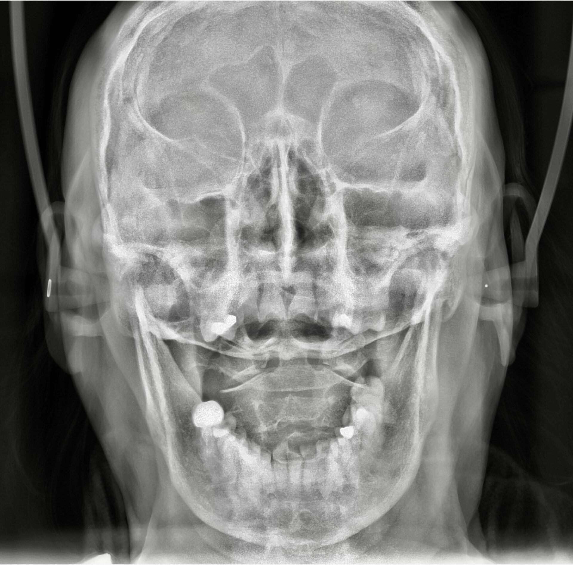 The Silent Suffering: Recognizing and Treating the Root Cause of TMJ ...
