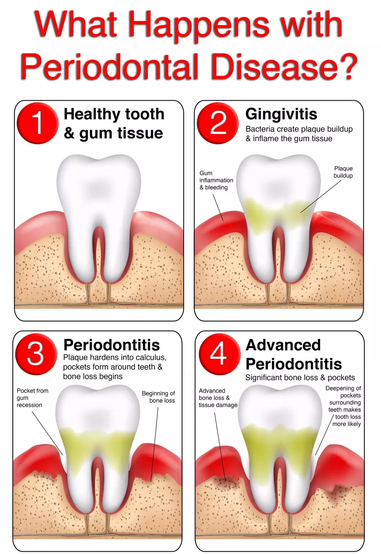 Understanding Periodontal Disease: Causes, Symptoms, and Treatment ...
