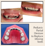 Pedi Partials For Upper Anterior Teeth Replacement: Reasons and ...