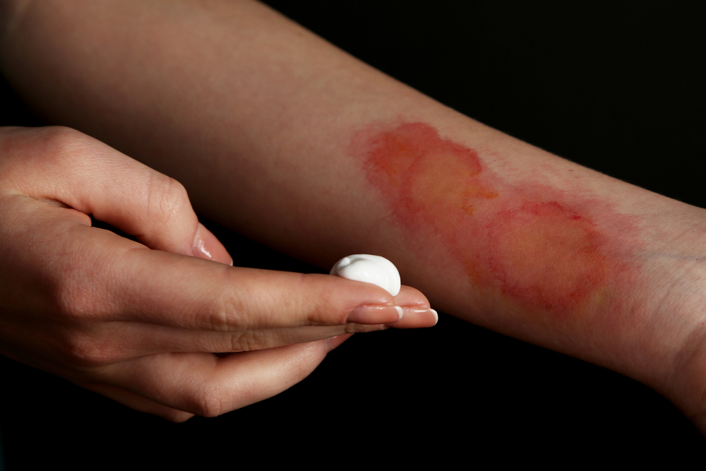 Dos and Don’ts During Burn Injuries - Your Health Magazine