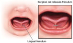 Tongue-Ties and Frenectomies - Your Health Magazine