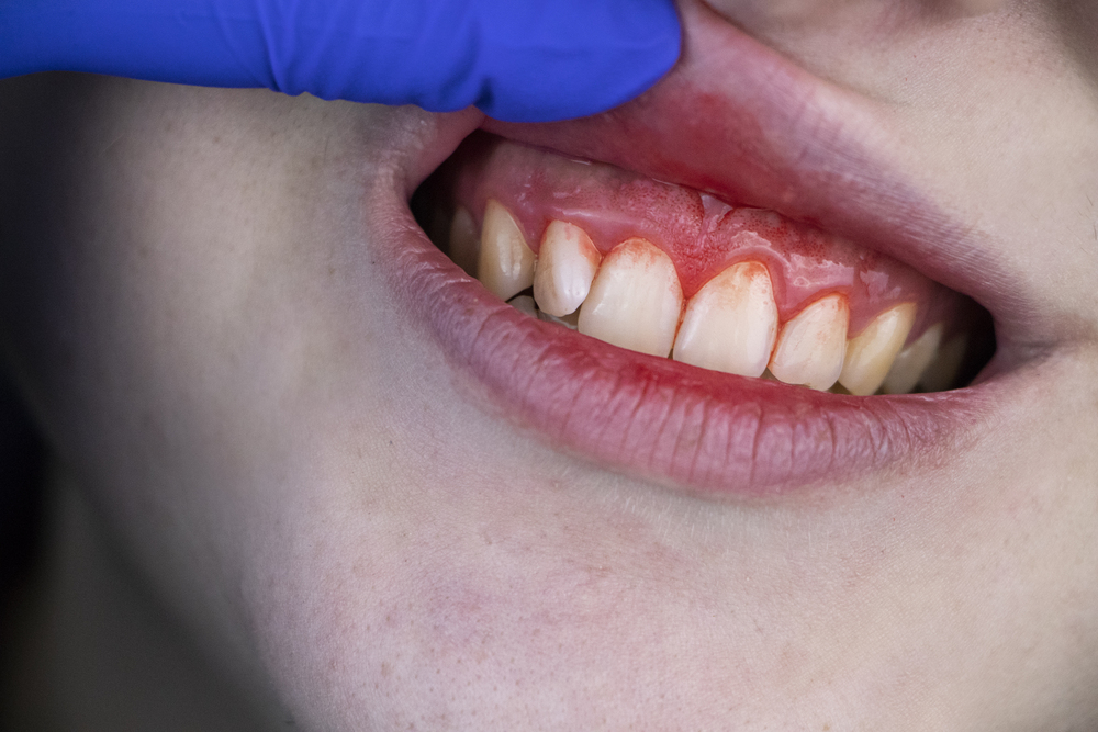 Diabetes & Gum Disease: A Critical Health Connection - Your Health Magazine