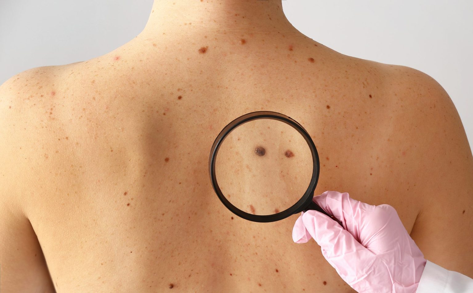 When To Get Checked For Skin Cancer: Risk Factors And Key Signs - Your ...
