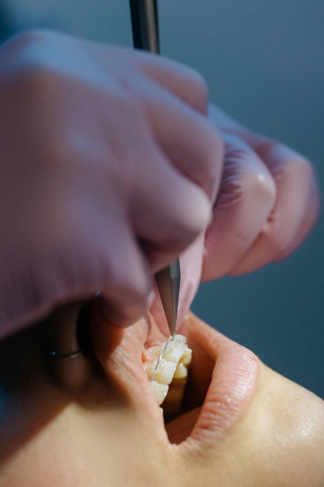 How to Care for Your Retainer: Expert Tips From Henderson Orthodontists ...