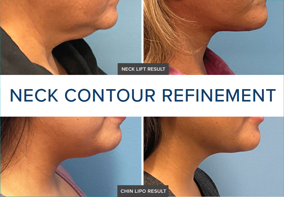 Facelift vs Neck Lift: The two second test to know for yourself! - Your ...