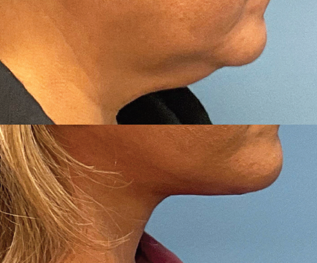 Five Ways to Make Recovery Smoother After Neck Lift Surgery - Your ...