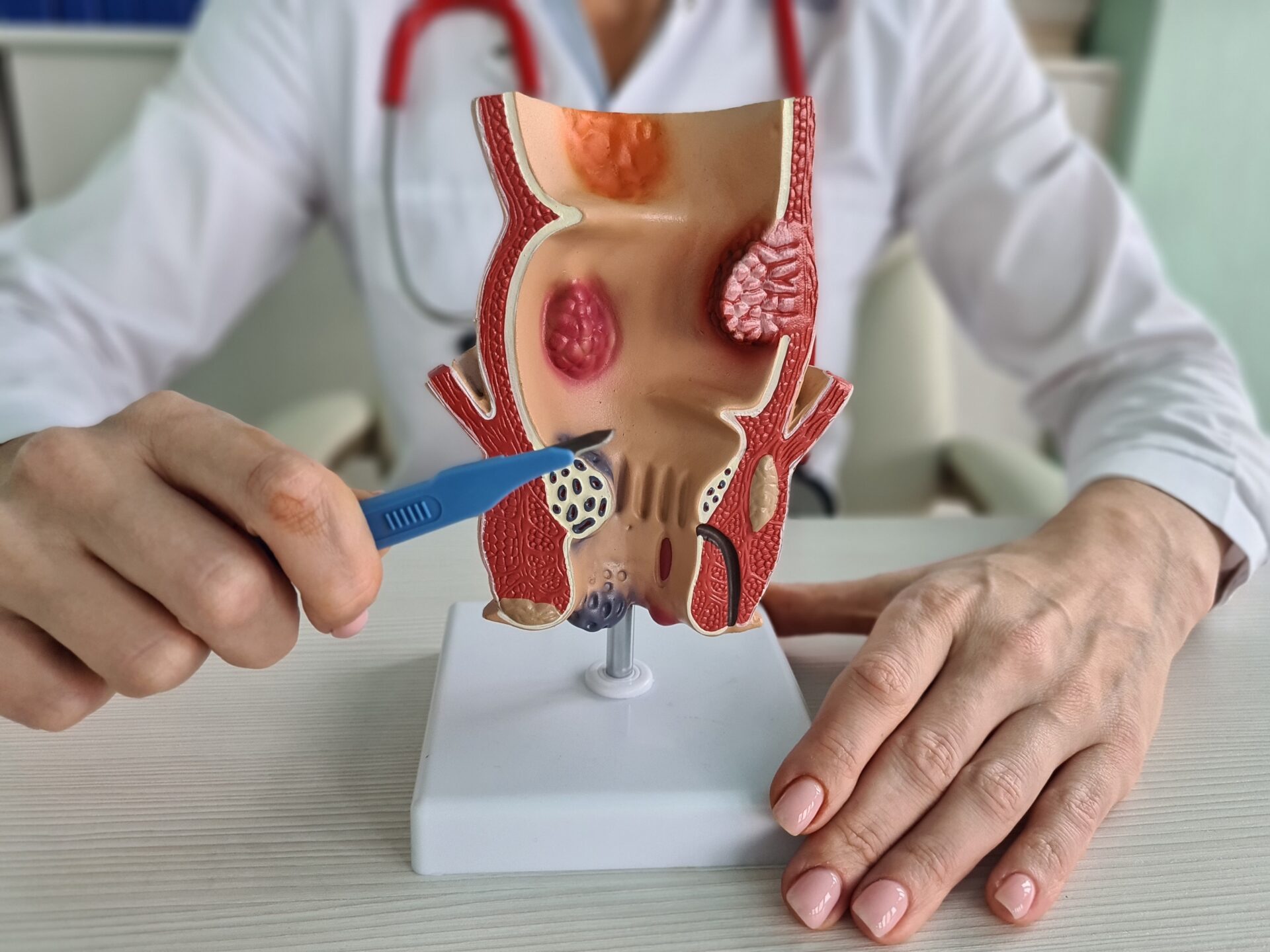 When Do Piles Need Surgery? What To Expect Before and After - Your ...