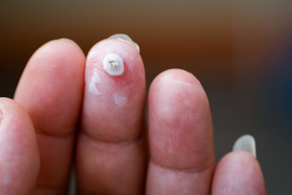 What Causes a White Bump on Your Finger and How to Treat It? - Your ...