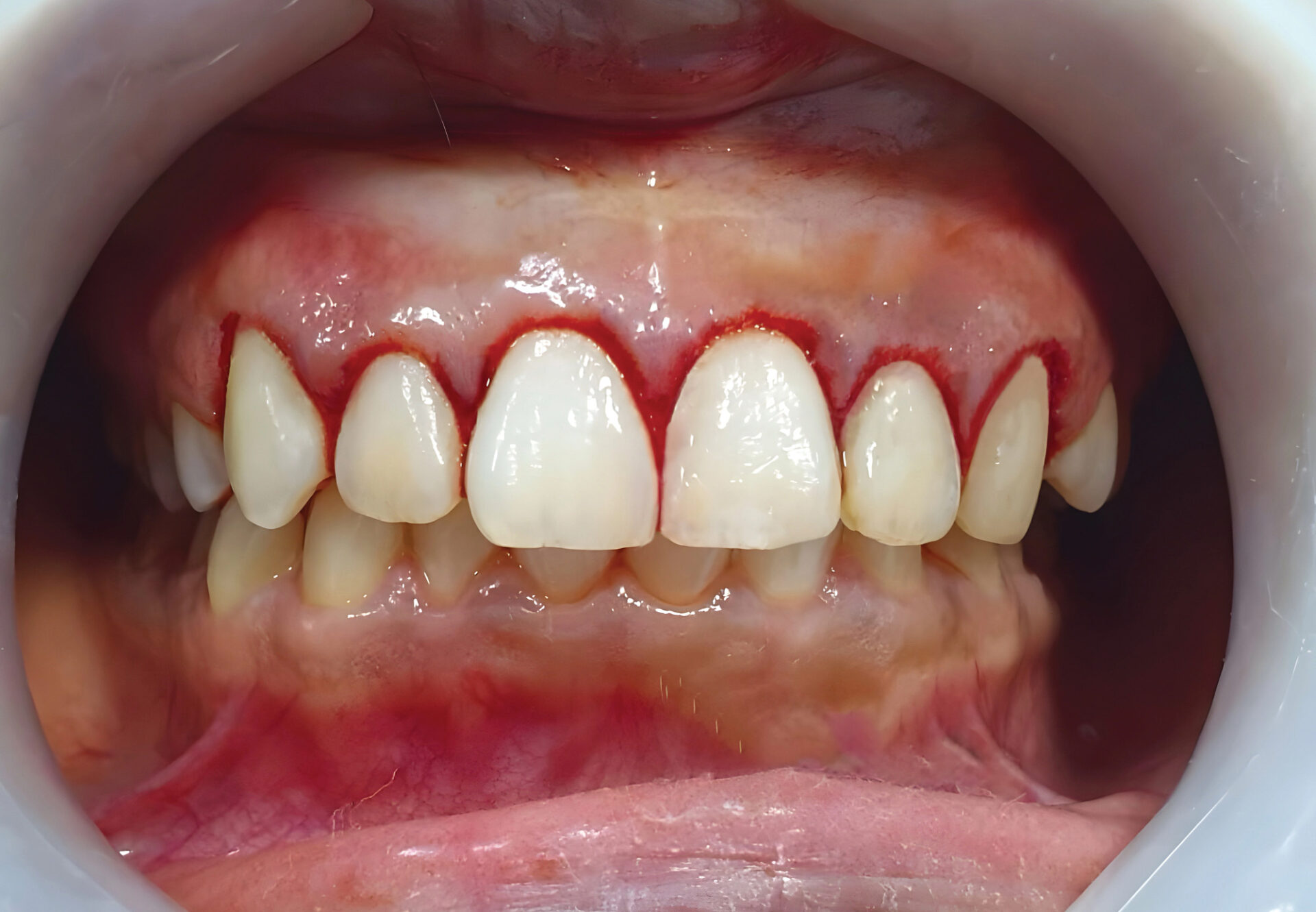 The Two-Way Relationship Between Gum Disease and Diabetes - Your Health ...