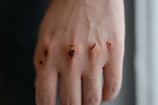 What Causes Induration Wounds and How Can You Treat Them? - Your Health ...