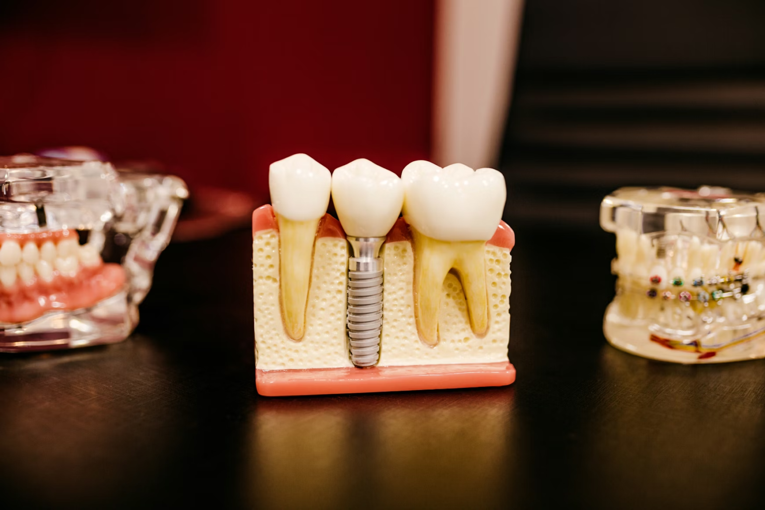 Dental Implants vs Dentures Cost and Benefits Explained - Your Health ...